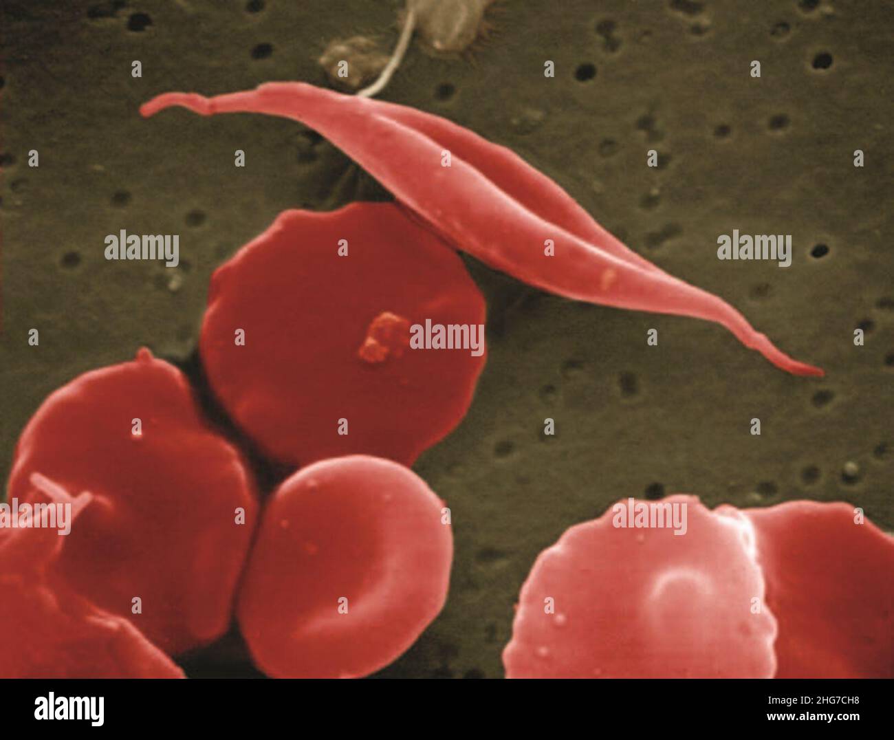 Sickle cells illustration Stock Photo - Alamy