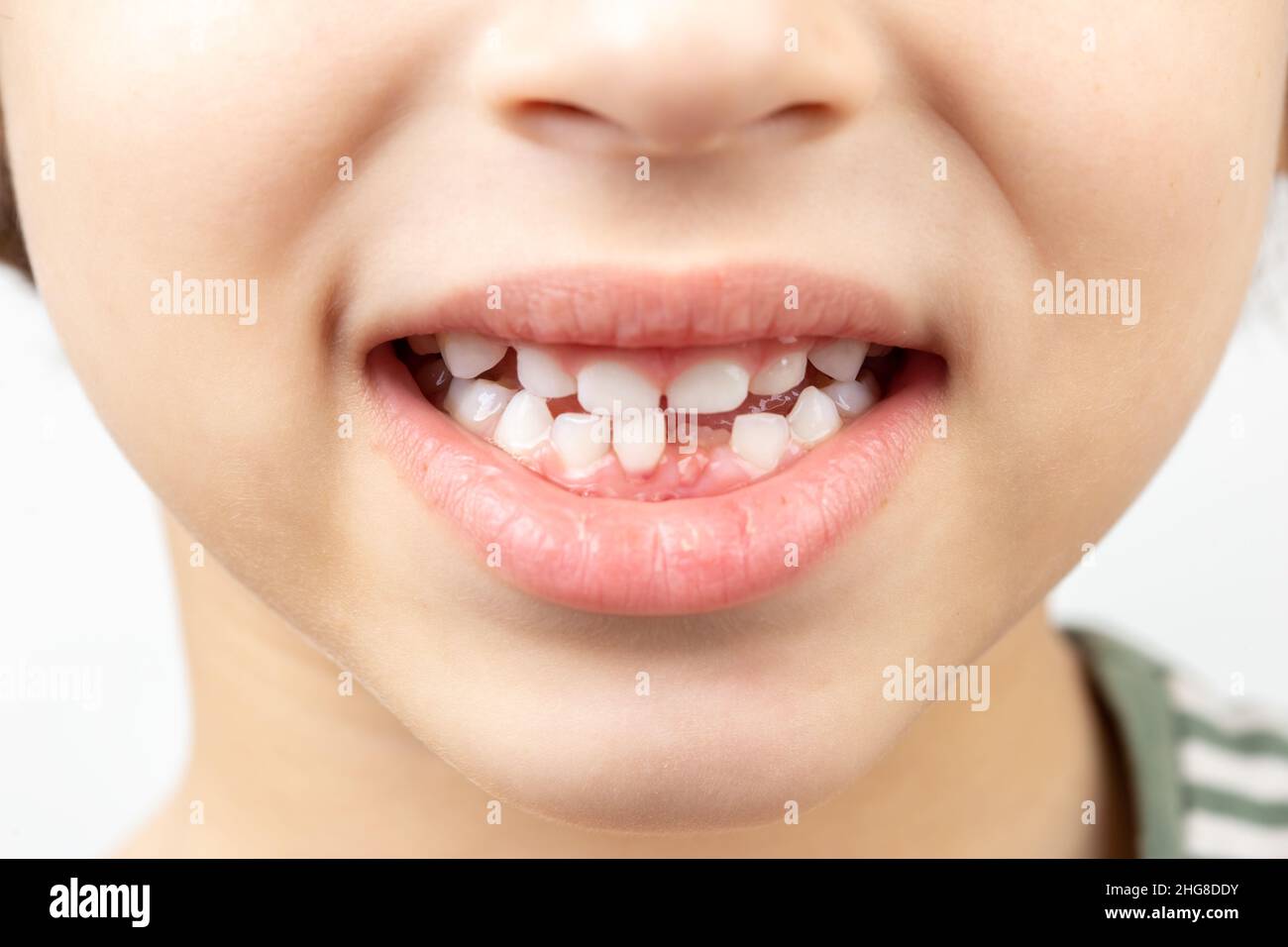 Close up of the child mouth without one bottom front tooth. Dental ...