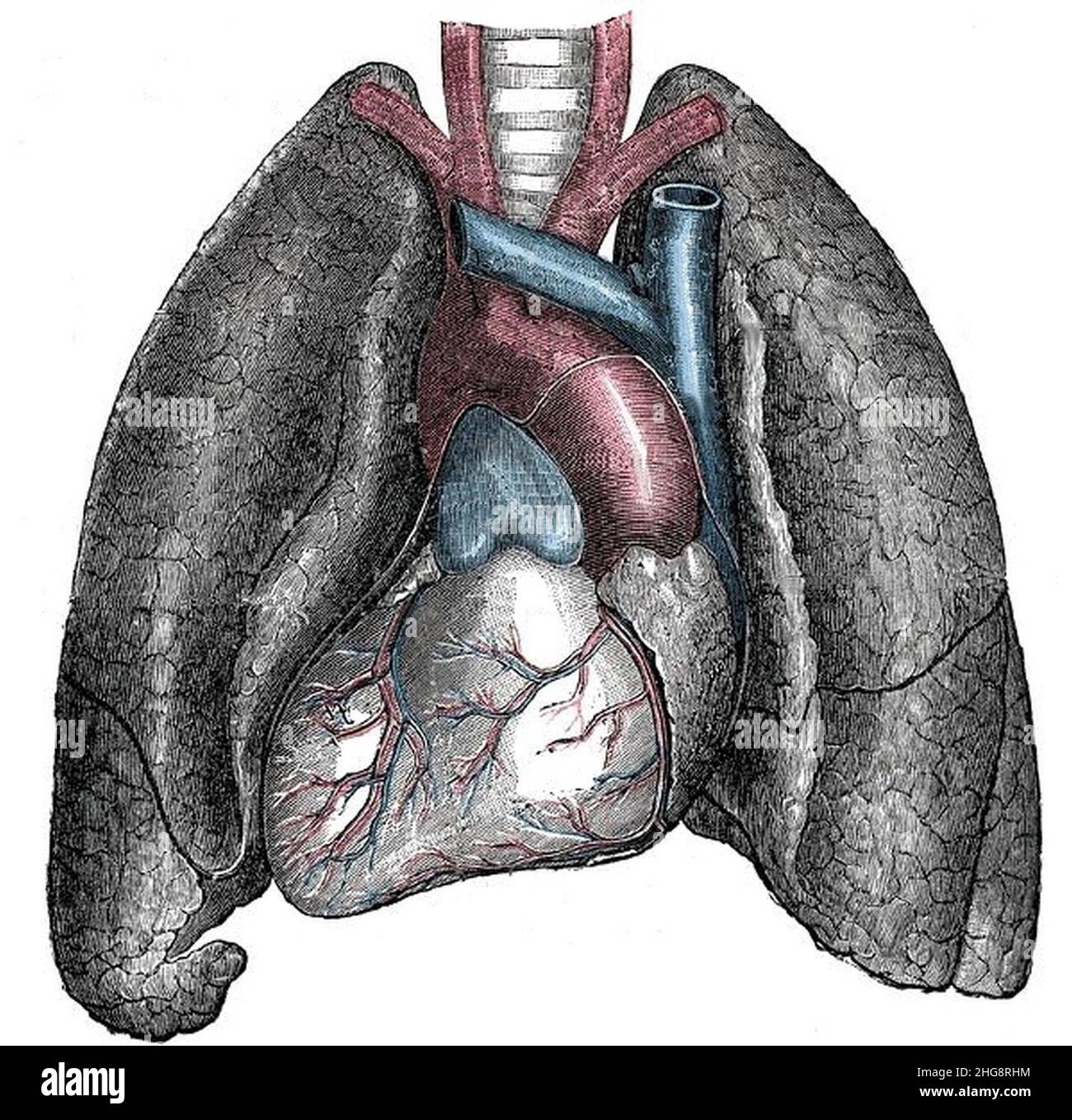 Situs inversus - Mirrored heart and lungs Stock Photo - Alamy