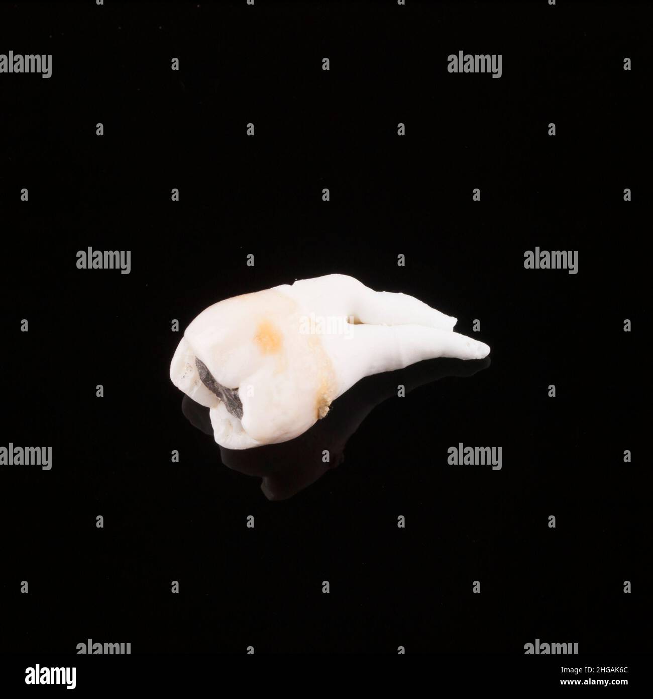 Molar tooth decay hi-res stock photography and images - Alamy