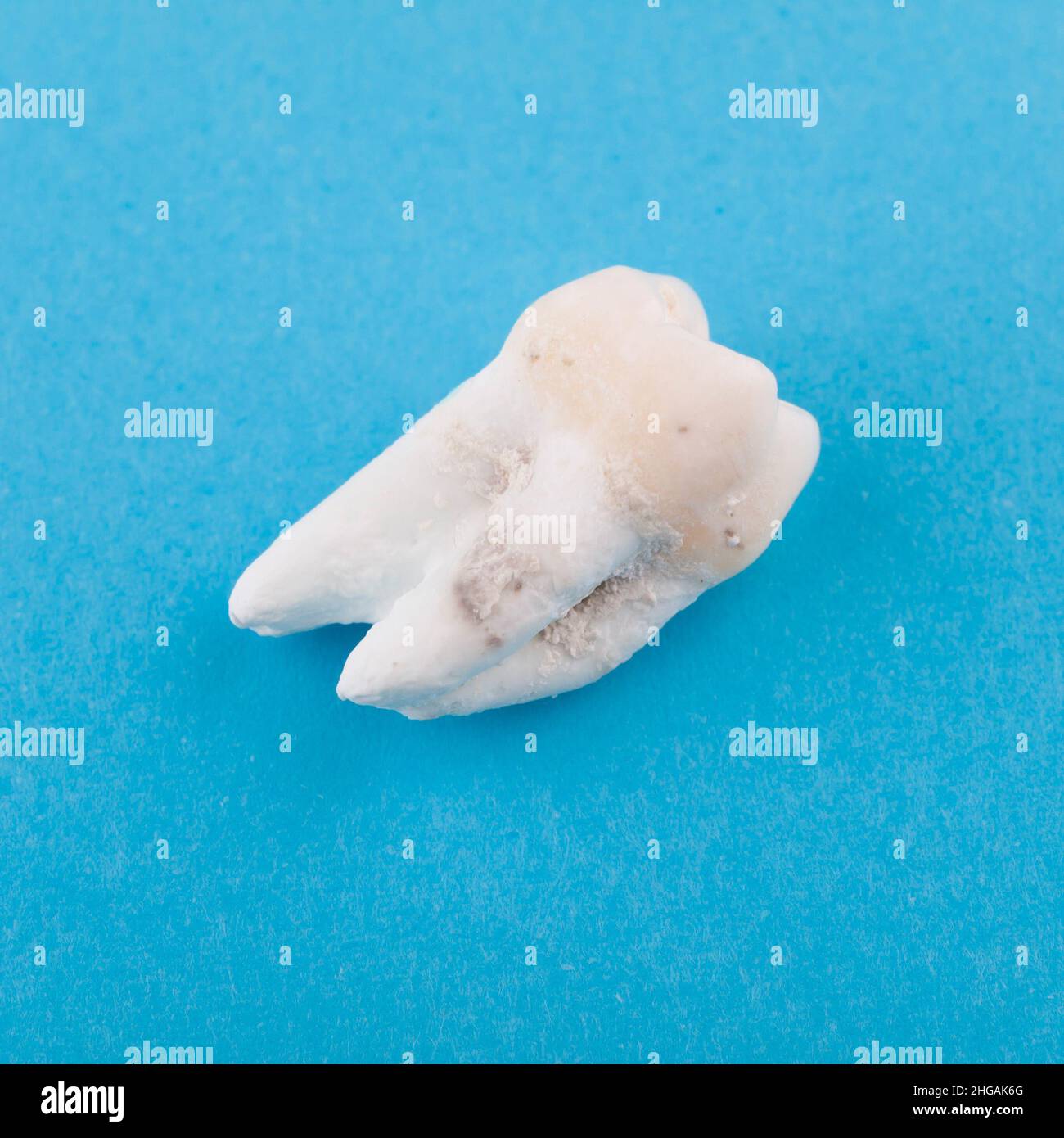 Tooth decayed hi-res stock photography and images - Alamy