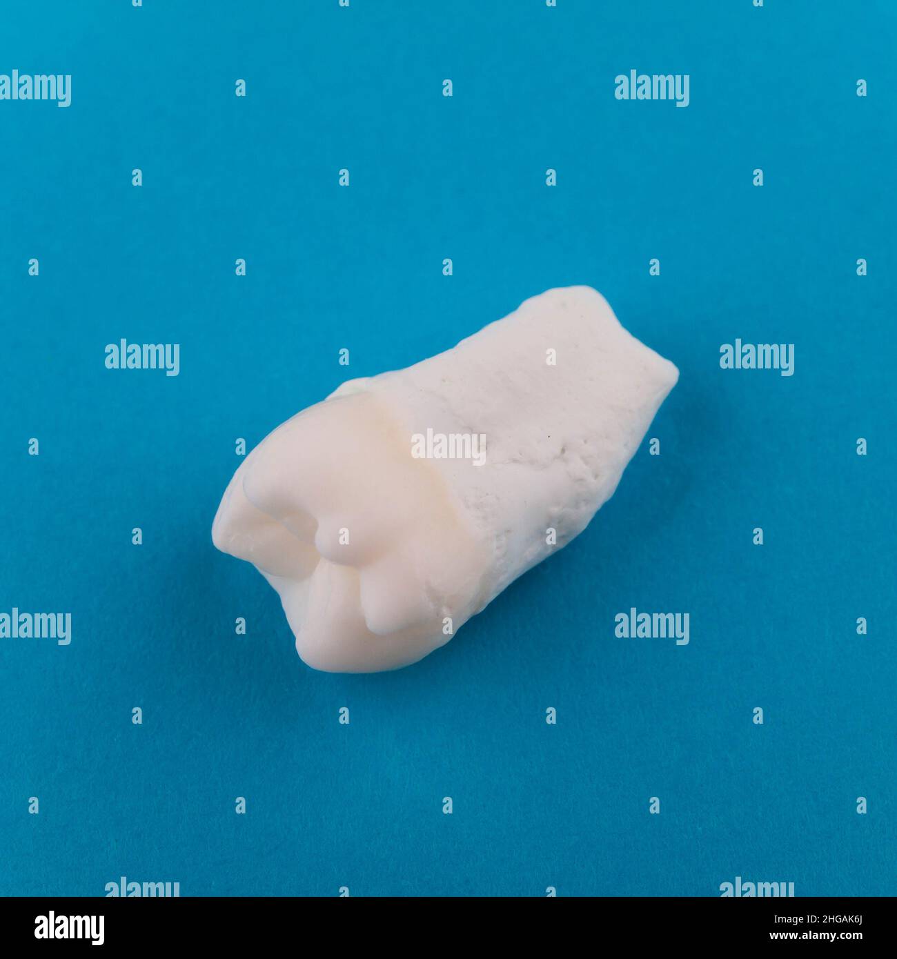 Molar tooth decay hi-res stock photography and images - Alamy