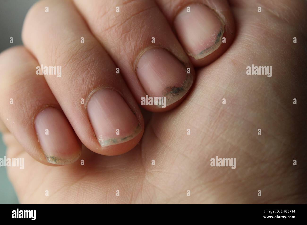 Fingernails brittle hi-res stock photography and images - Alamy