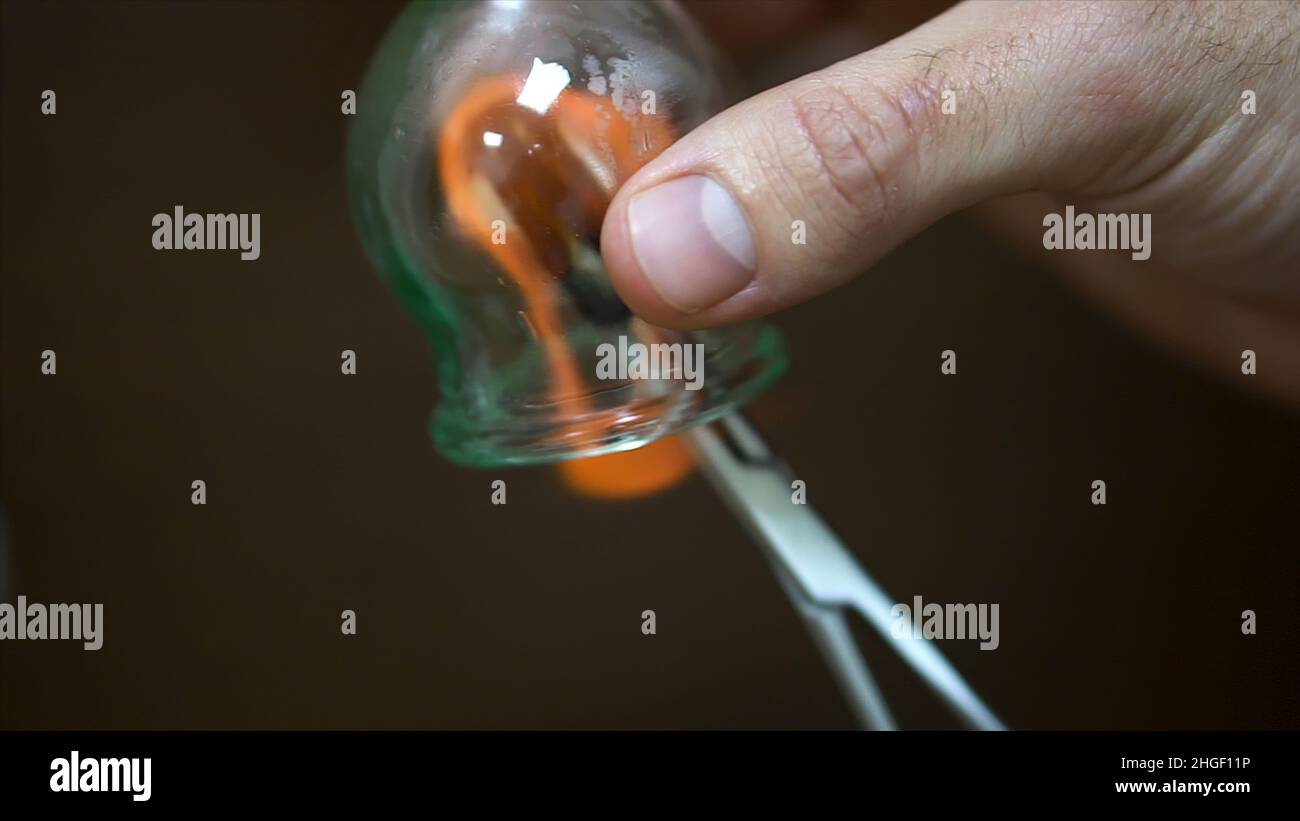 Close up for cupping therapist hand heating up a cupping glass with a ...