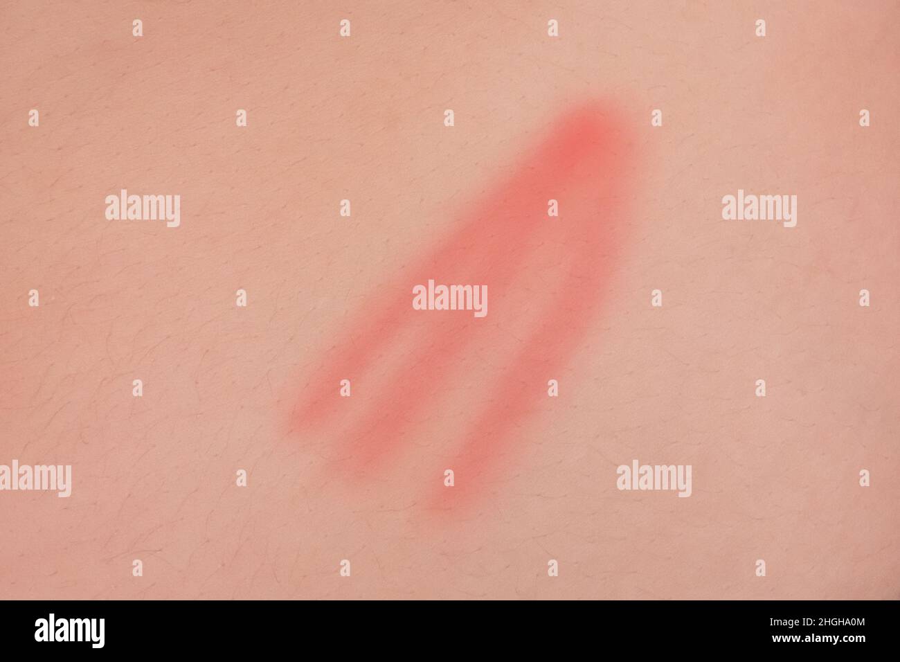 Scab scar hi-res stock photography and images - Alamy