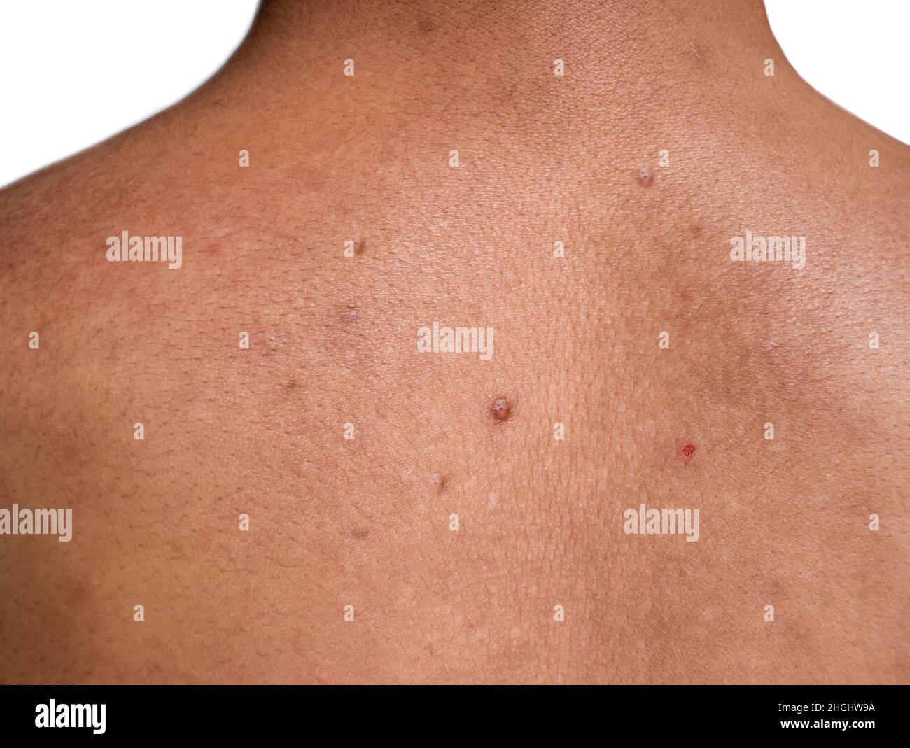 Ace on the back called backne of Asian, Myanmar man Stock Photo - Alamy