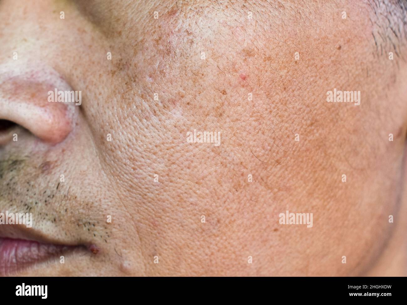 Large facial gland hi-res stock photography and images - Alamy
