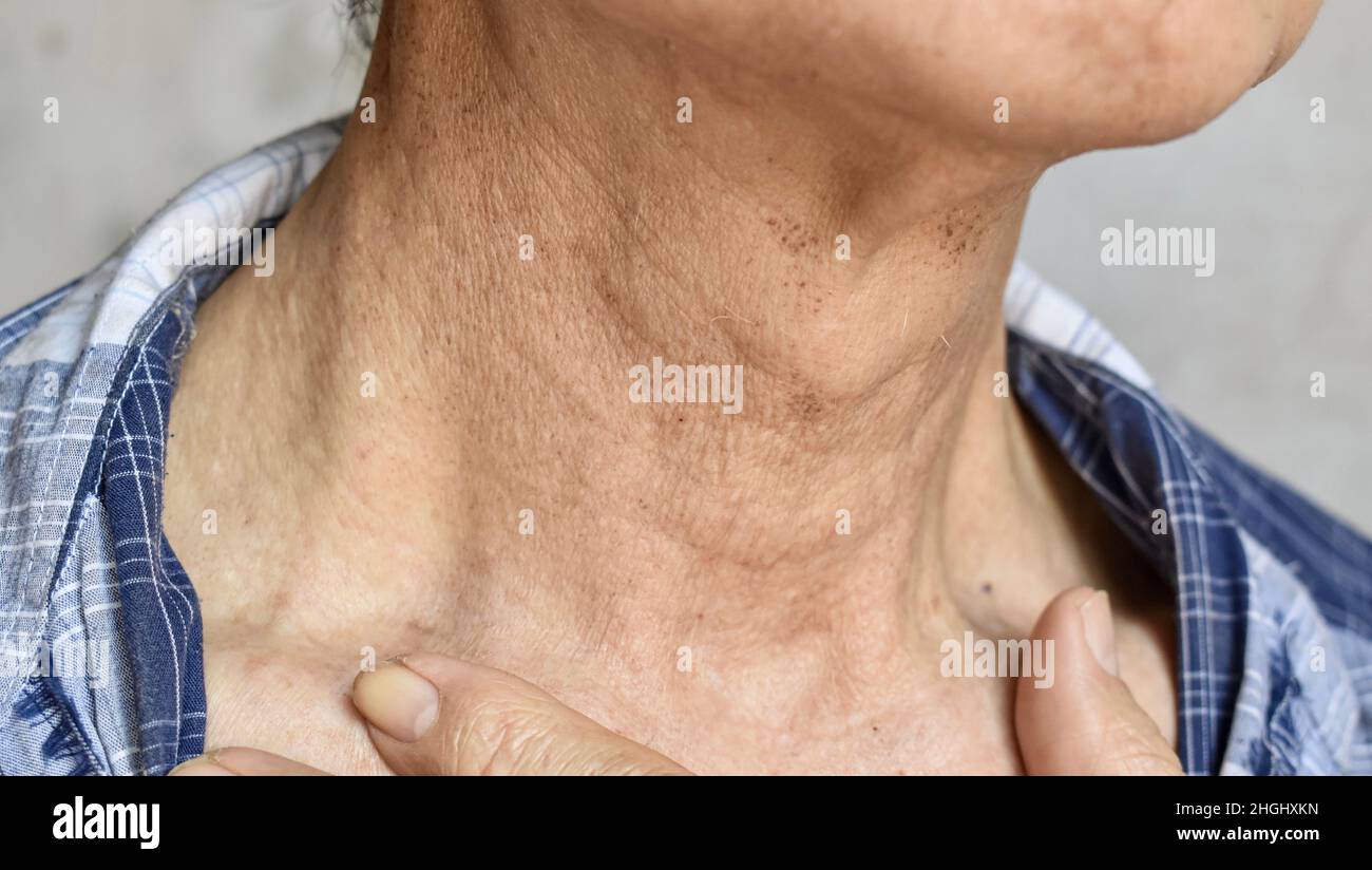 Aging skin folds or skin creases or wrinkles at neck of Southeast Asian ...