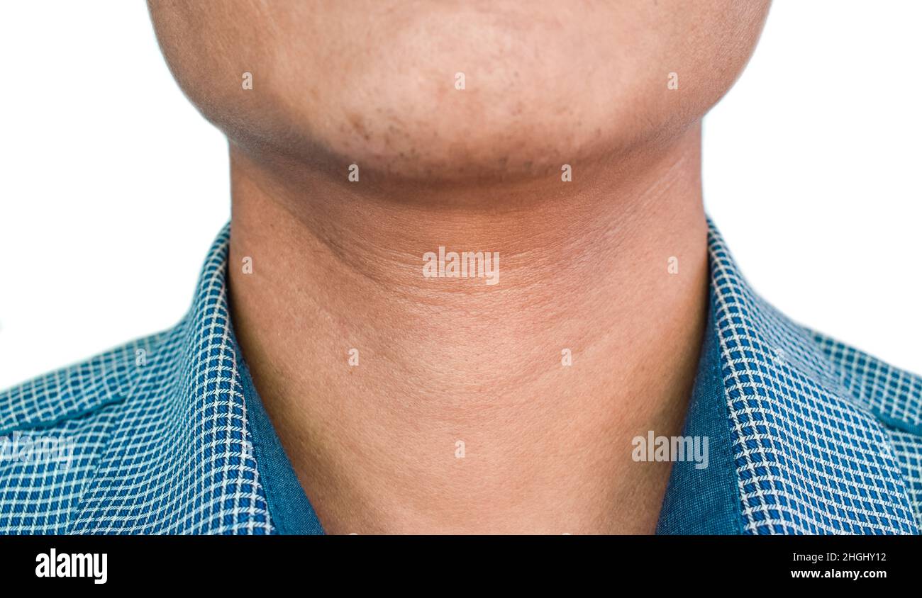 Aging skin folds or creases or wrinkles at neck of Southeast Asian ...