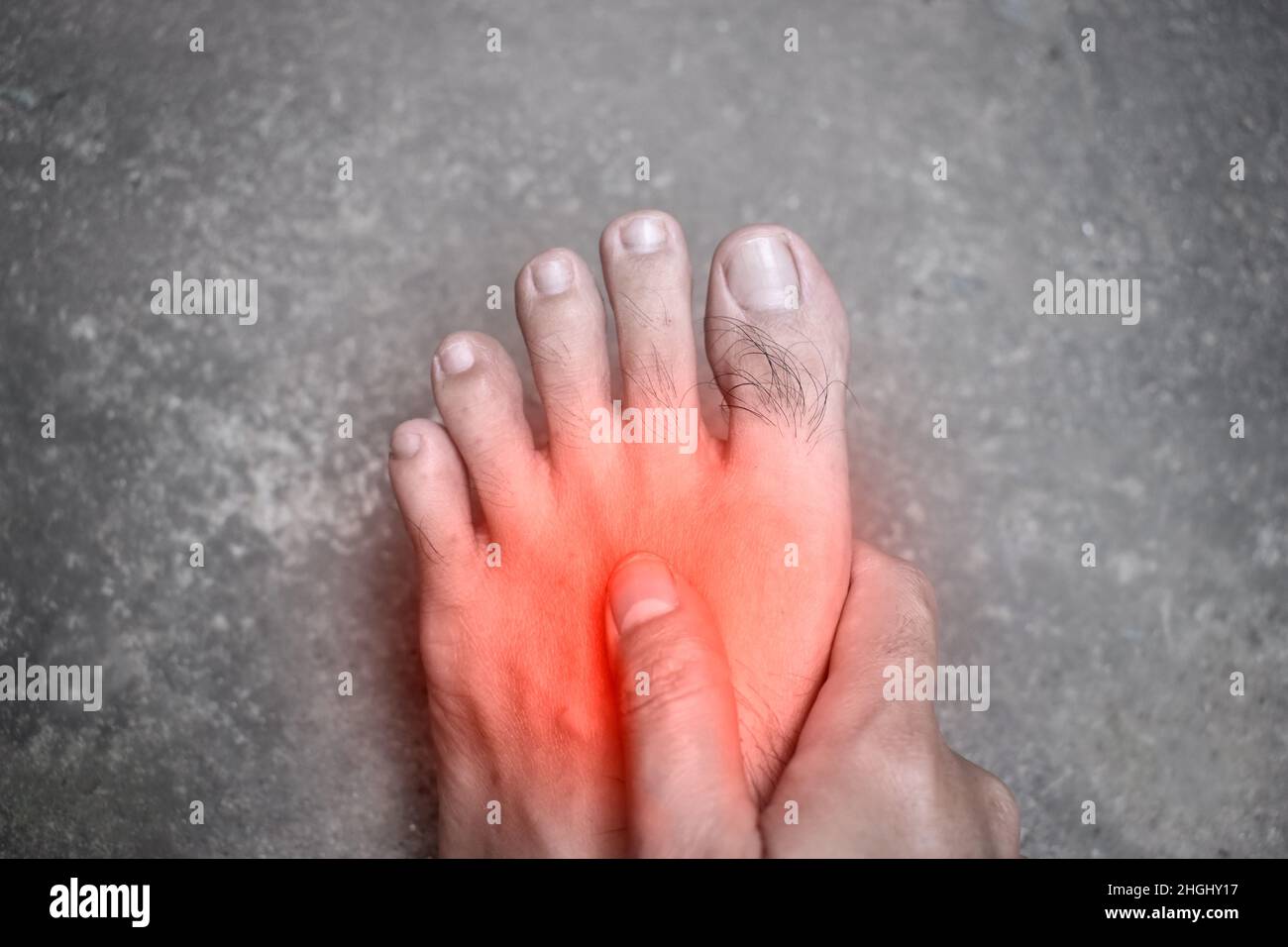 Painful foot of Asian young man with diabetes. Sensory neuropathy ...