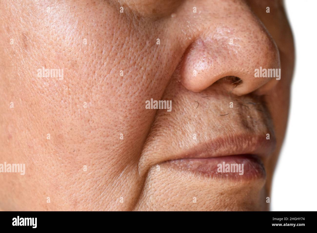 Large Pores On Cheeks