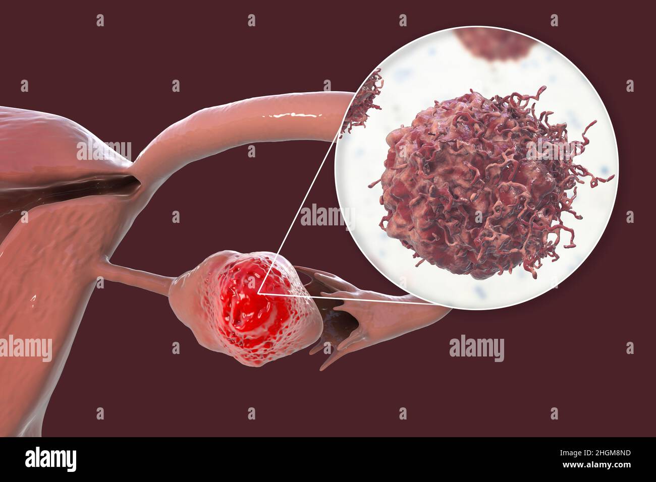 Ovarian cancer, illustration Stock Photo - Alamy