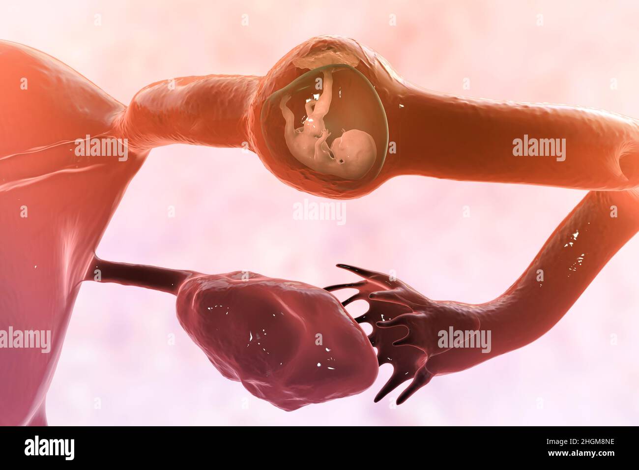 Ectopic pregnancy, illustration Stock Photo - Alamy