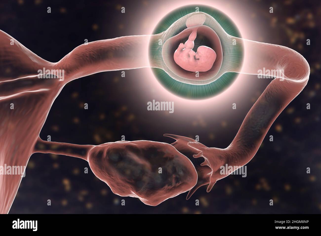 Ectopic pregnancy hi-res stock photography and images - Alamy