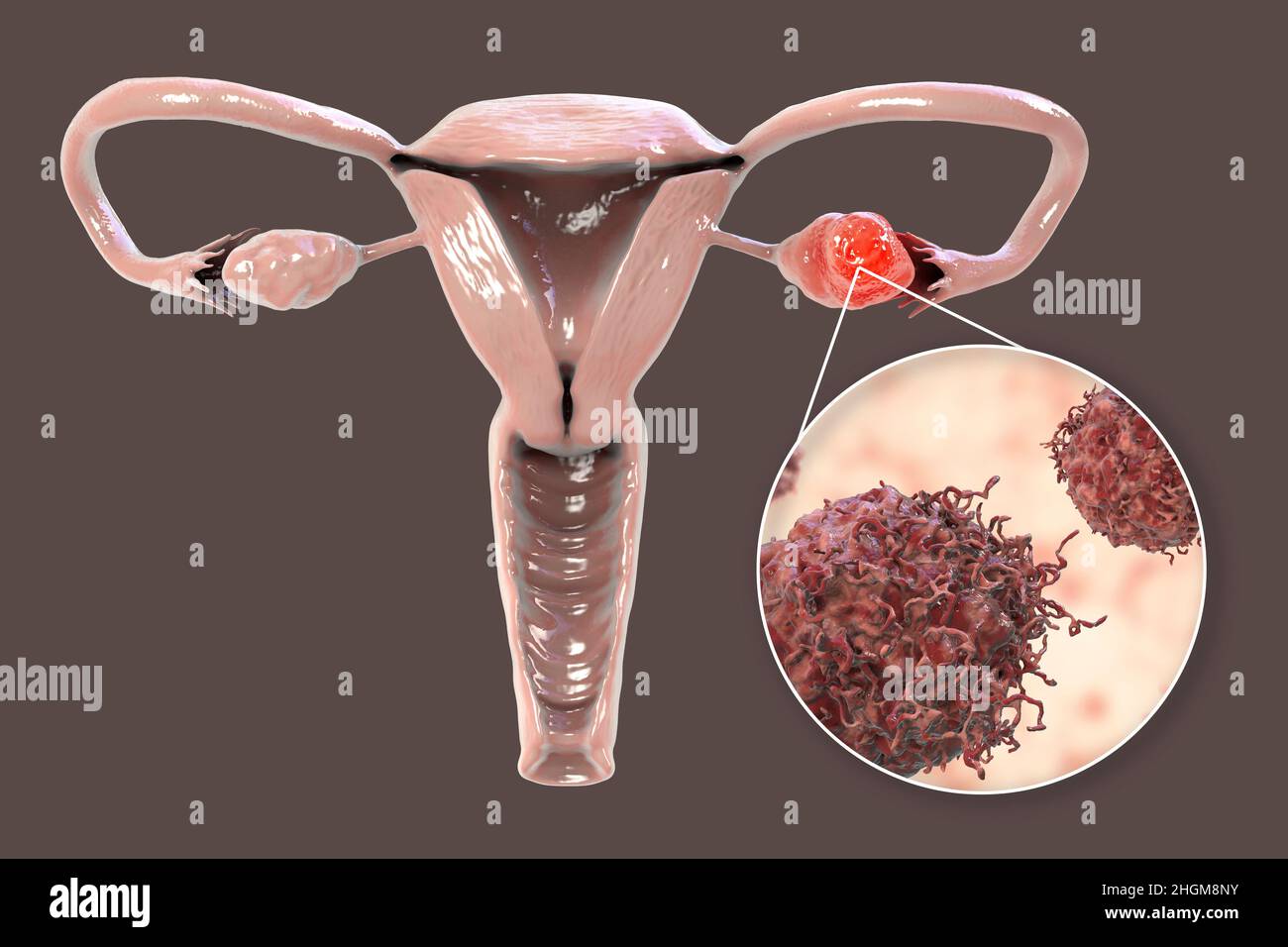 Ovarian cancer cells hi-res stock photography and images - Alamy