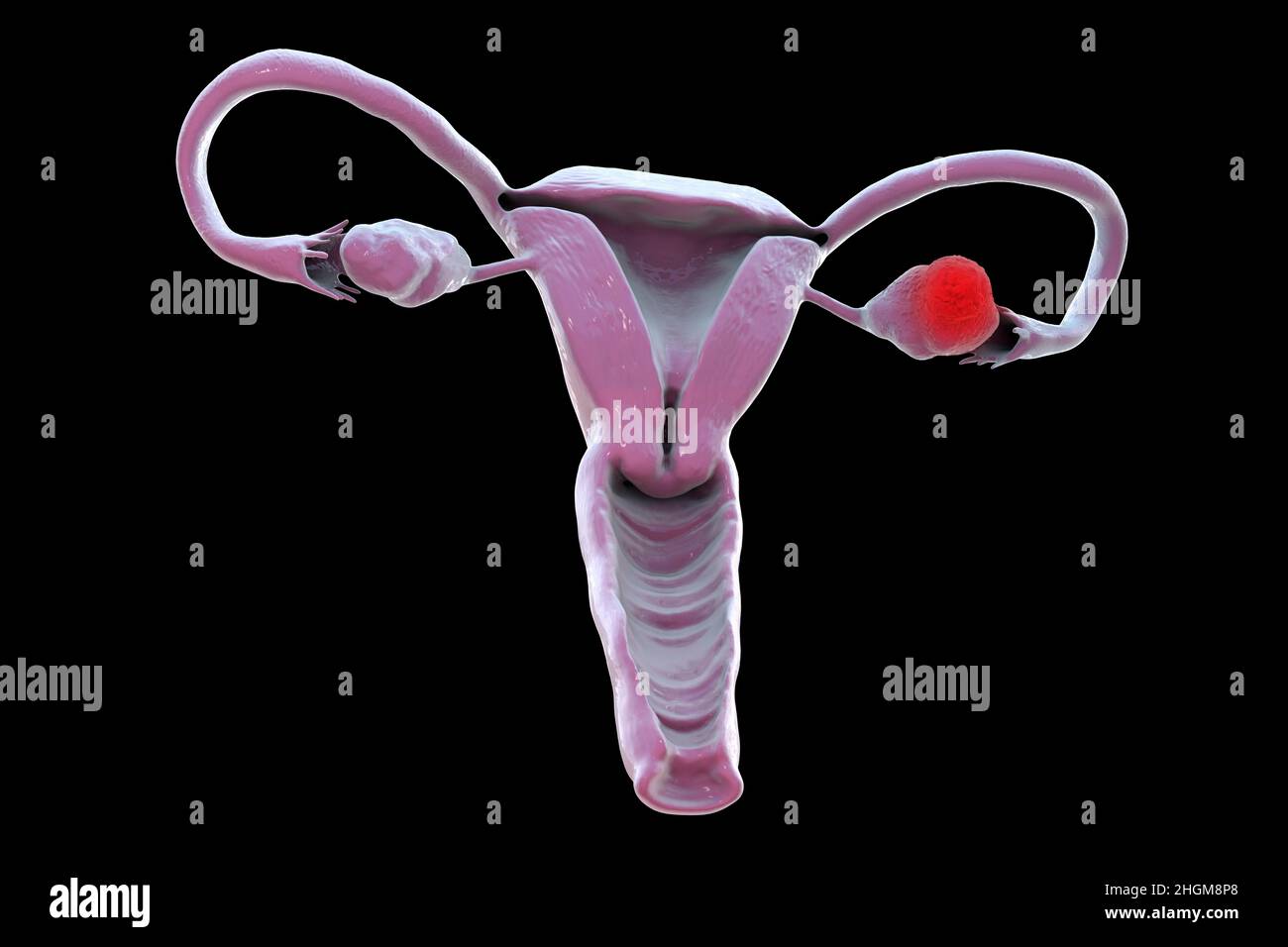 Ovarian cancer, illustration Stock Photo - Alamy