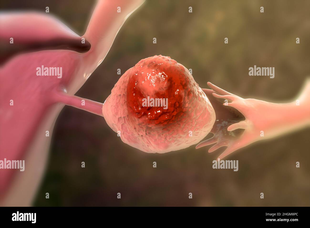 Ovarian cancer, illustration Stock Photo - Alamy