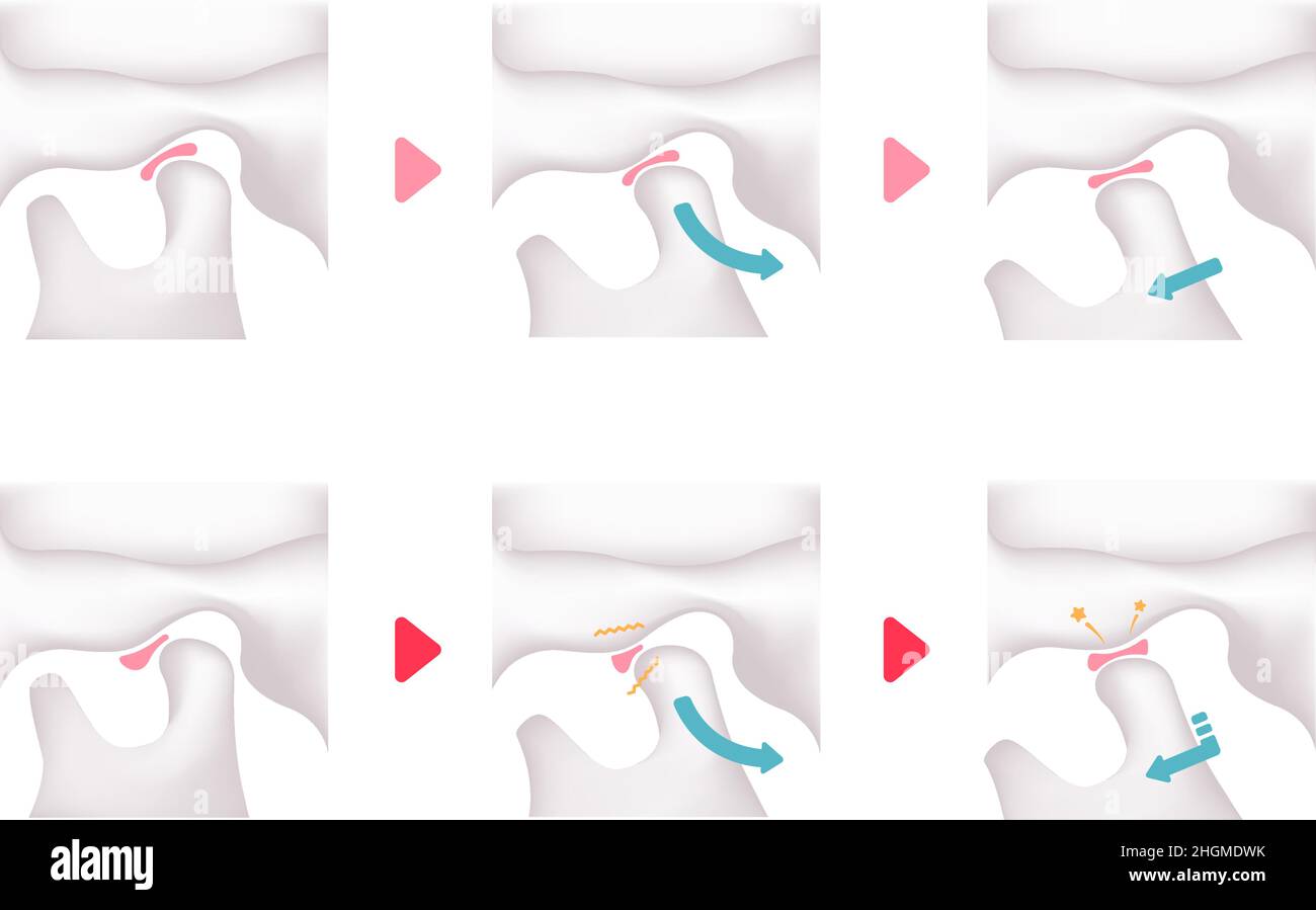 Comparison illustration of normal jaw and Temporomandibular disorders ...