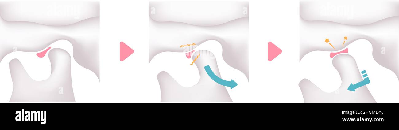 Illustration of the cause of temporomandibular disorders (TMD Stock ...