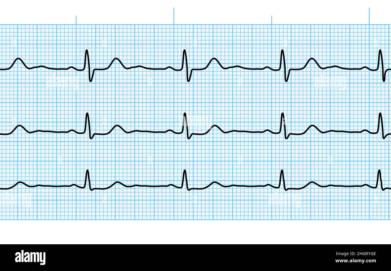 Heart beat ecg or ekg seamless black line on blue paper ...