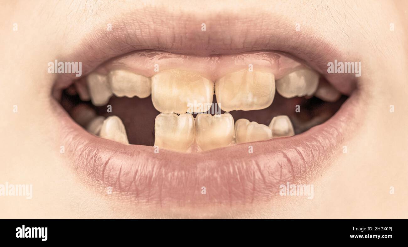 Bad teeth child. Portrait boy with bad teeth. Child smile and show her ...