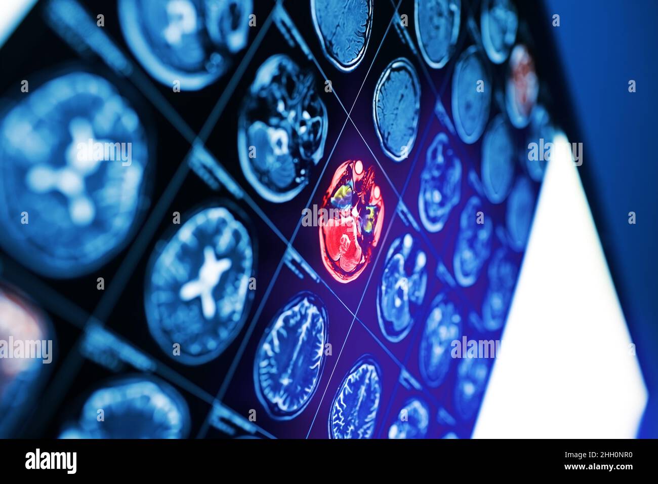 Brain cancer mri hi-res stock photography and images - Alamy