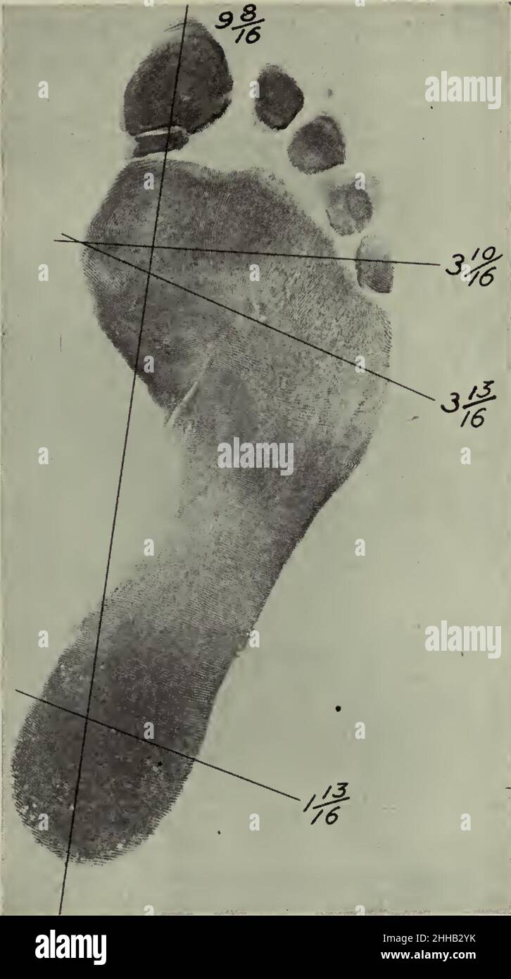 Soldiersfootmili00munsrich Fig15 Footprint of the same foot as shown in ...