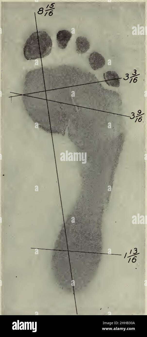 Soldiersfootmili00munsrich Fig13 A normal footprint taken with the ...