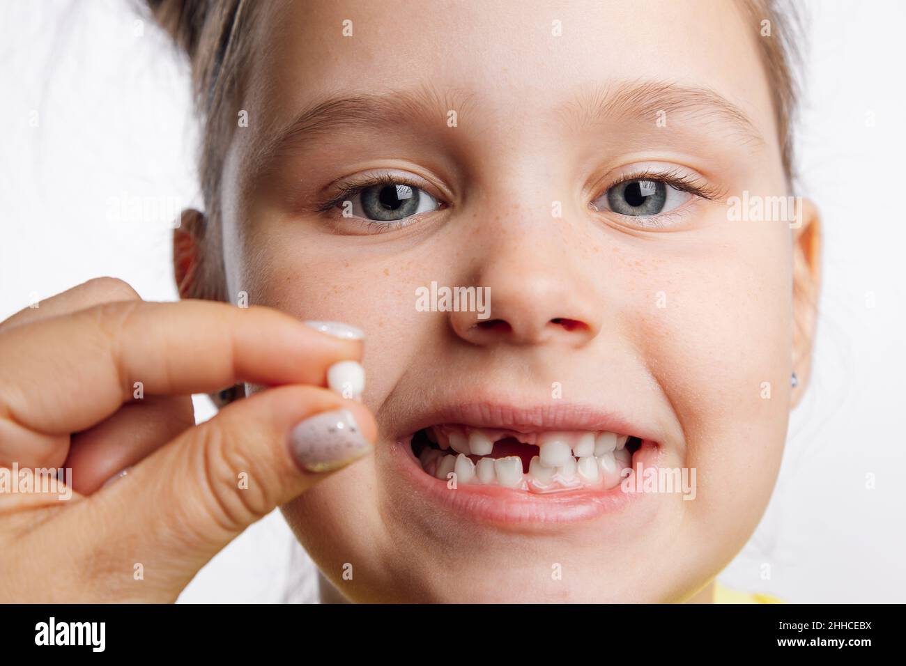 Torn out milk tooth between two fingers in front of little girl face ...