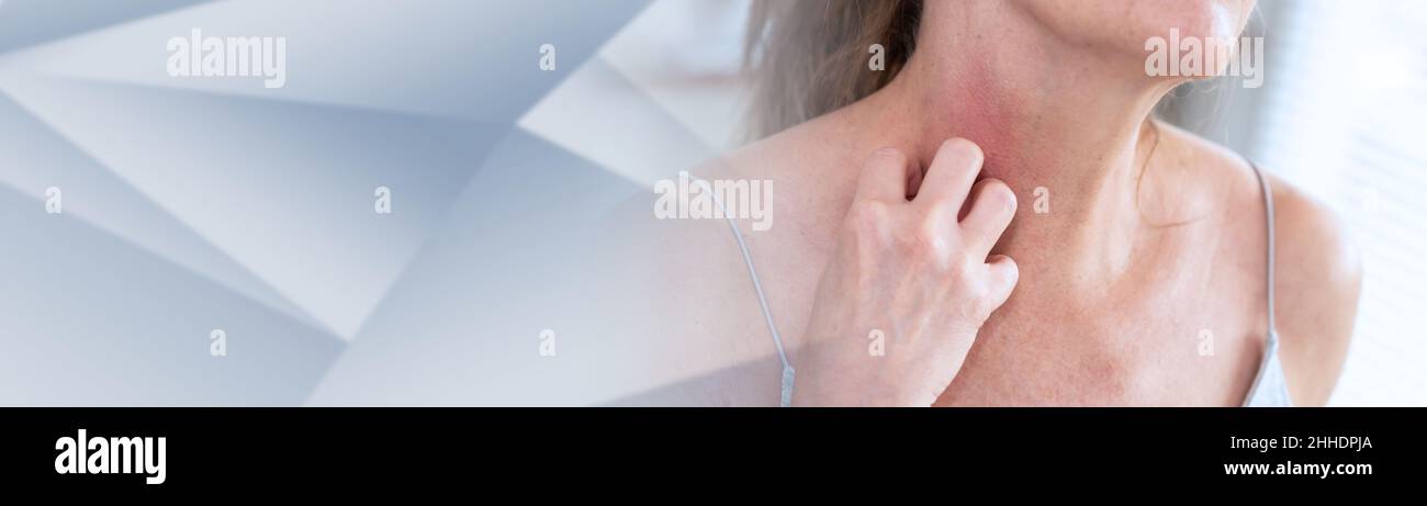 Woman having itchy and scratching her neck. allergy symptoms; panoramic ...