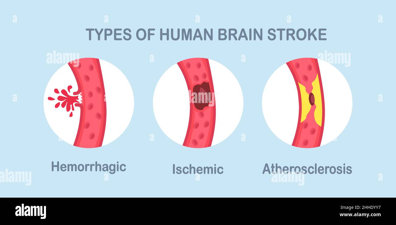 Types Of Stroke Stock Vector Images - Alamy