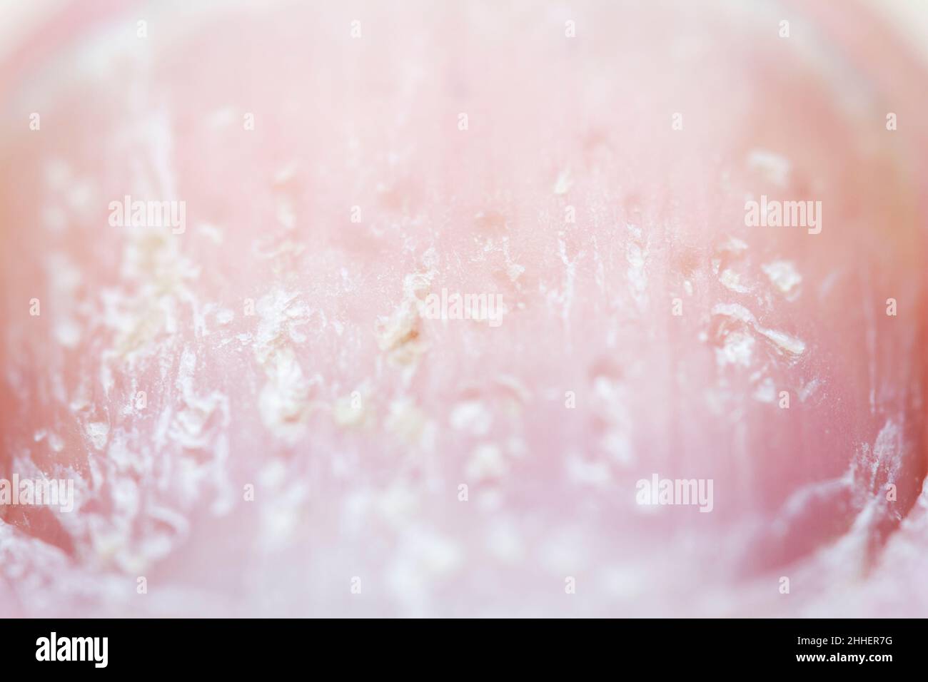 Extreme close up of psoriasis at the nail. Psoriasis is an autoimmune ...