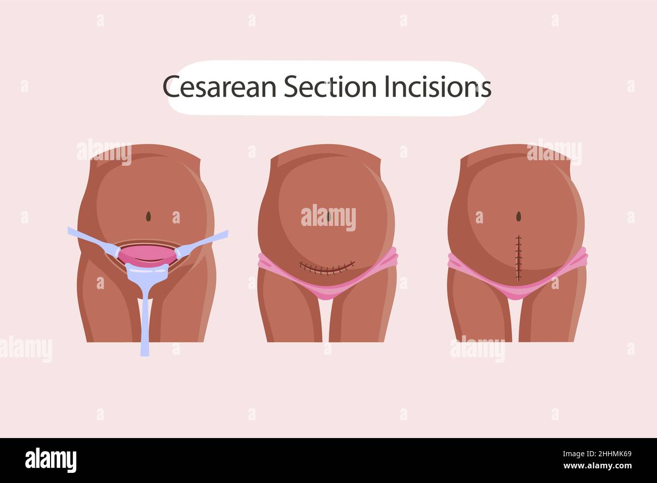 Hand drawn flat design cesarean section Vector illustration Stock Vector Image & Art - Alamy