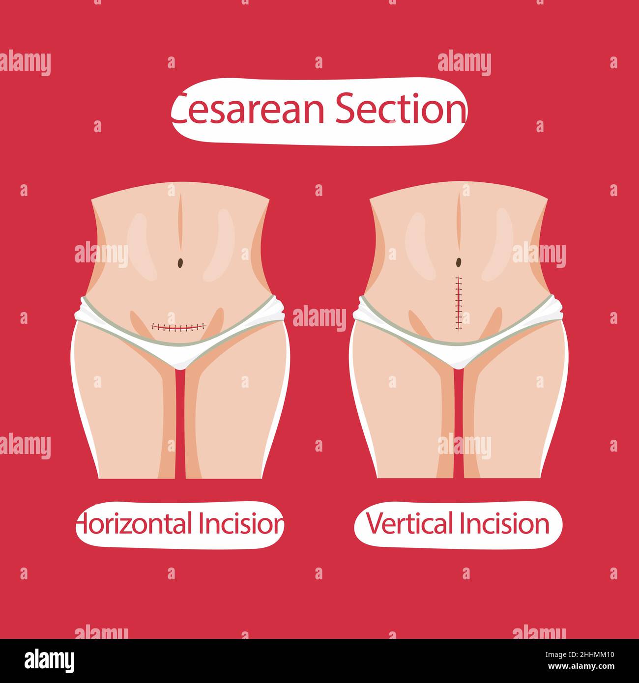 Hand drawn flat design cesarean section Vector illustration Stock Vector Image & Art - Alamy