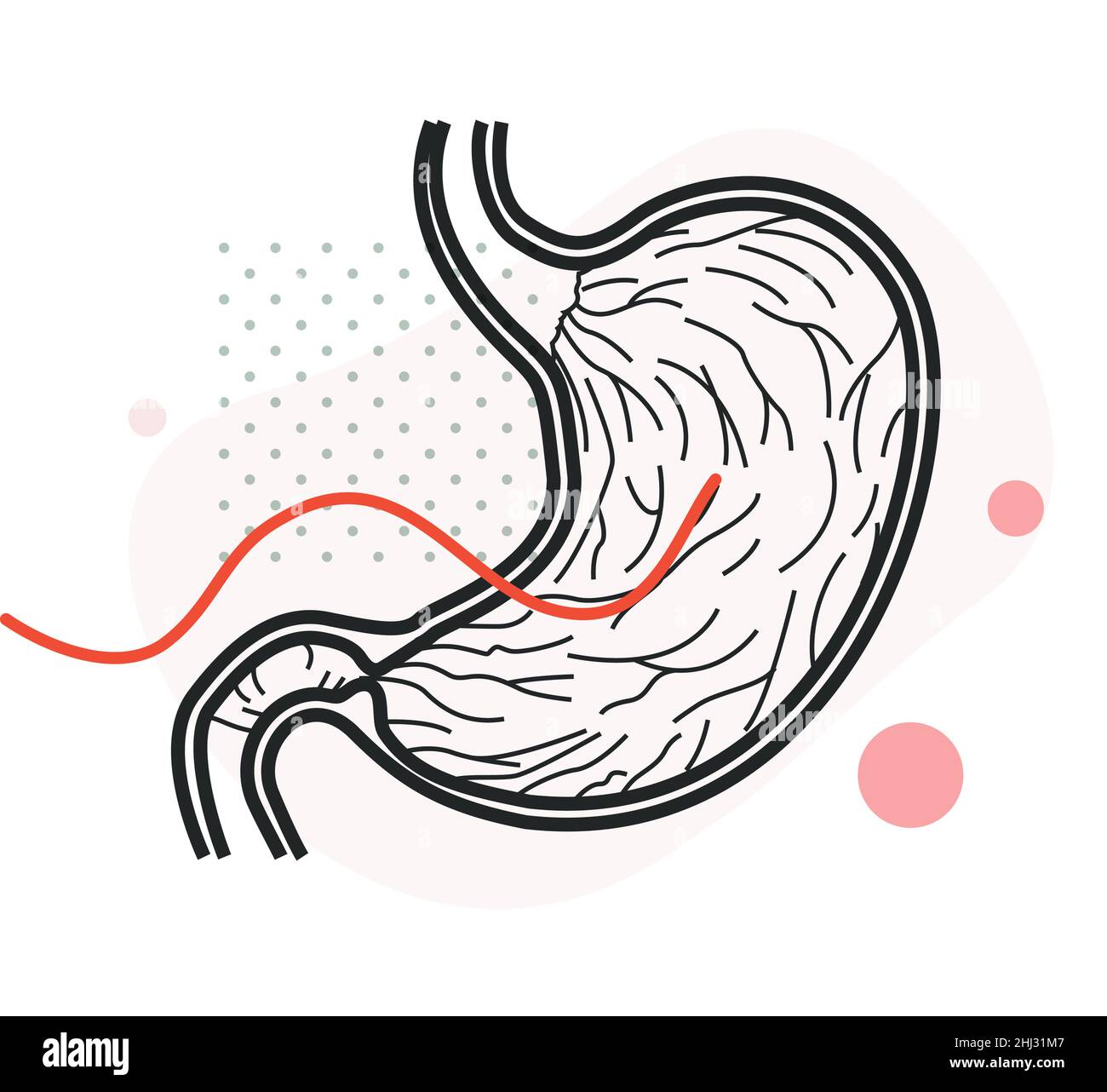 Peptic ulcer stomach hi-res stock photography and images - Alamy