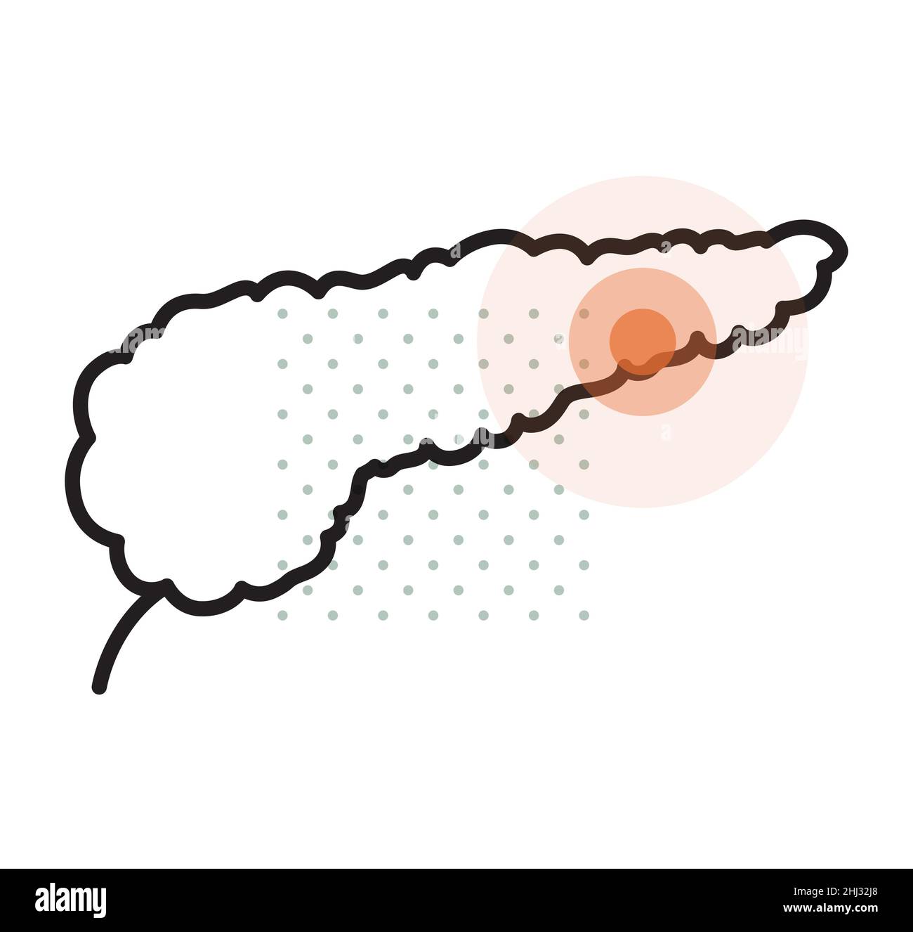 Pancreas acute pancreatitis hi-res stock photography and images - Alamy