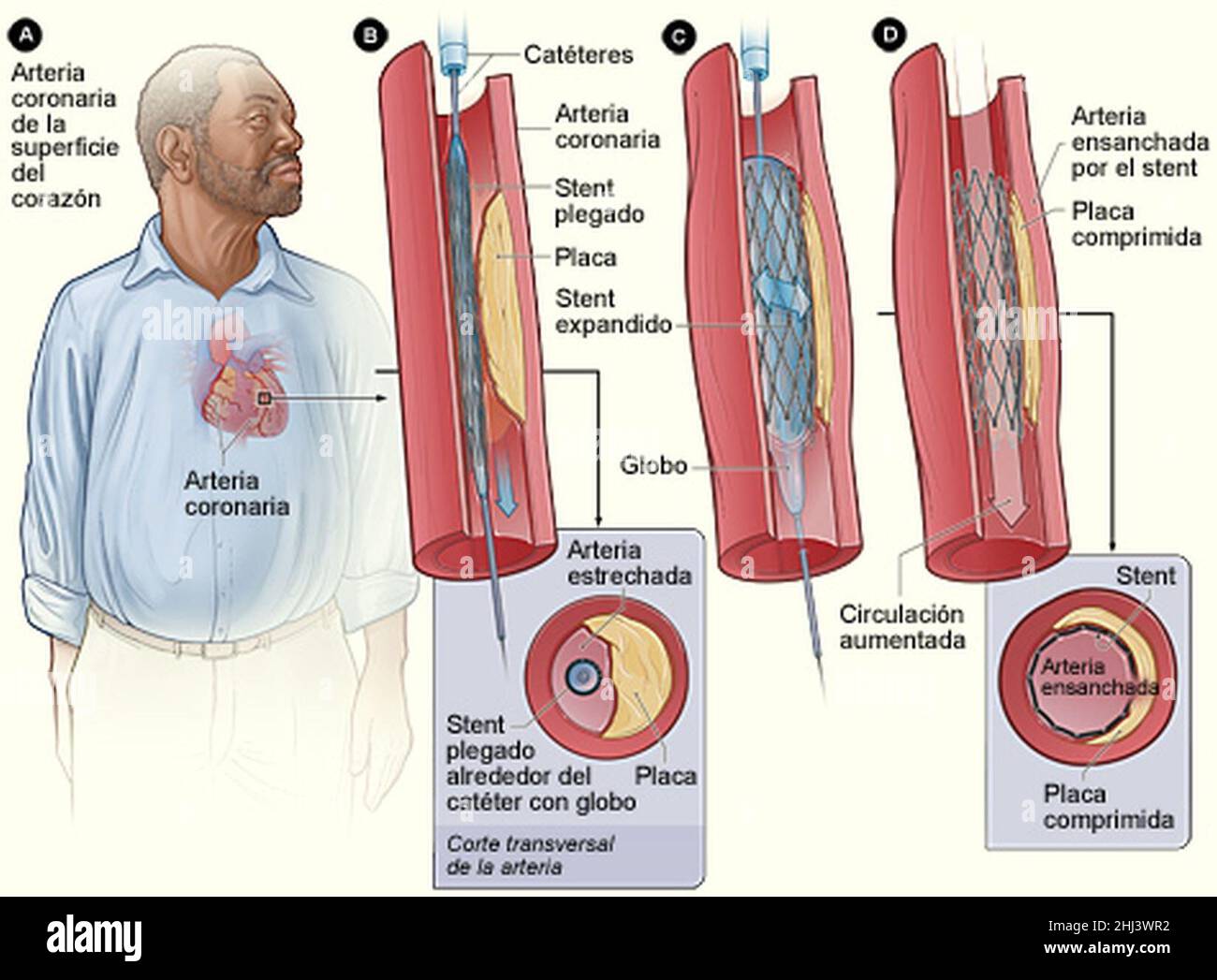 Stent placement hi-res stock photography and images - Alamy