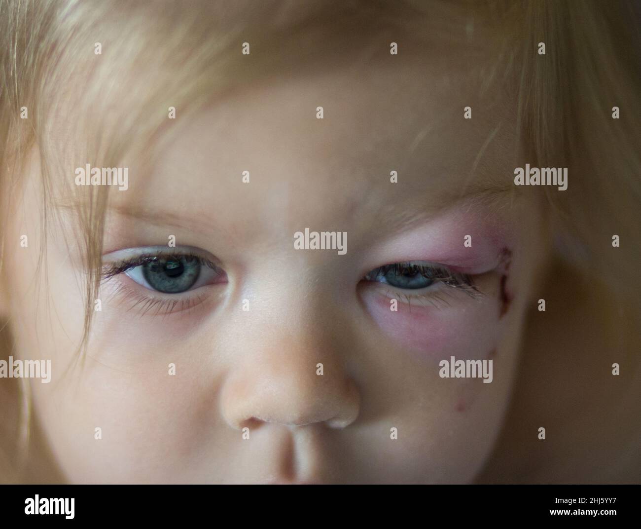 Portrait of caucasian child of two years old with bruise on face on ...