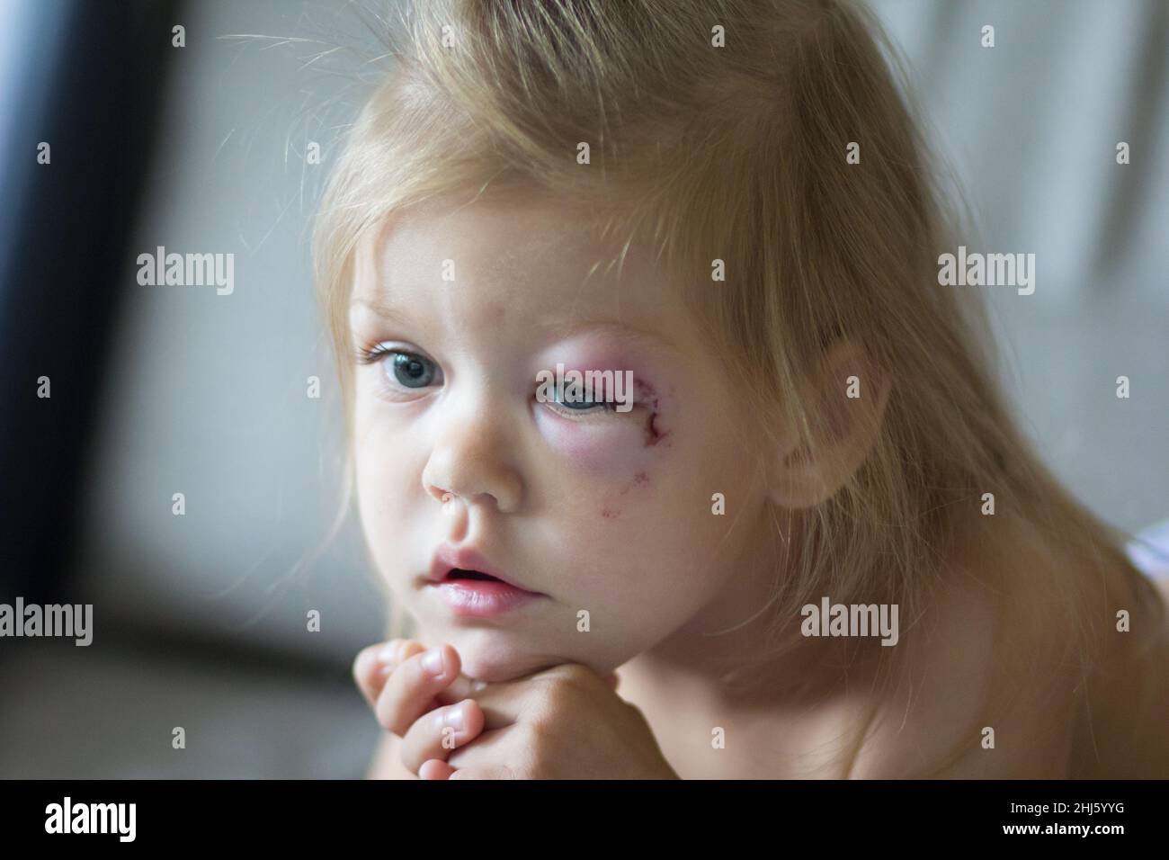 Portrait of caucasian child of two years old with bruise on face on ...