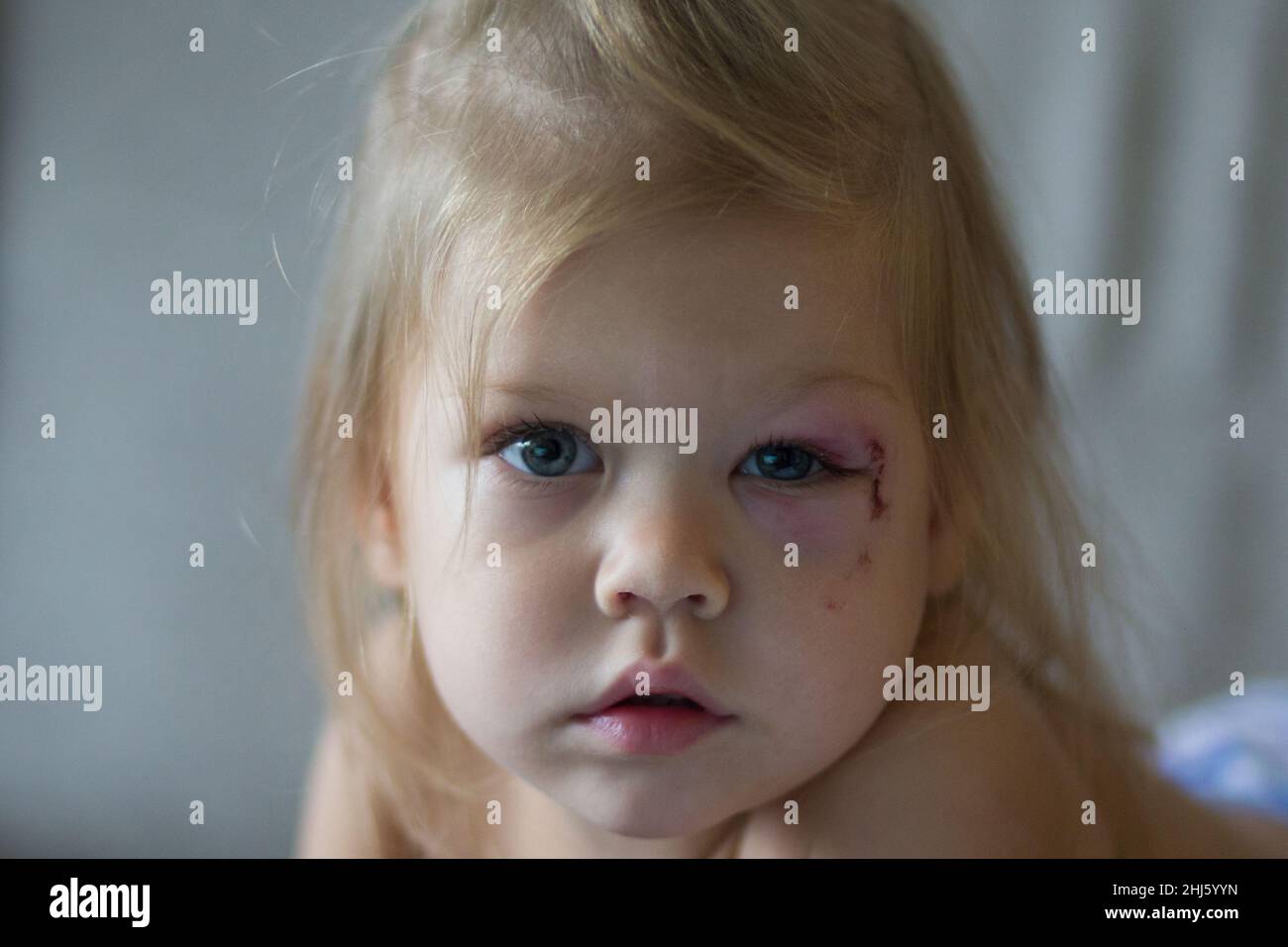 Portrait of caucasian child of two years old with bruise on face on ...