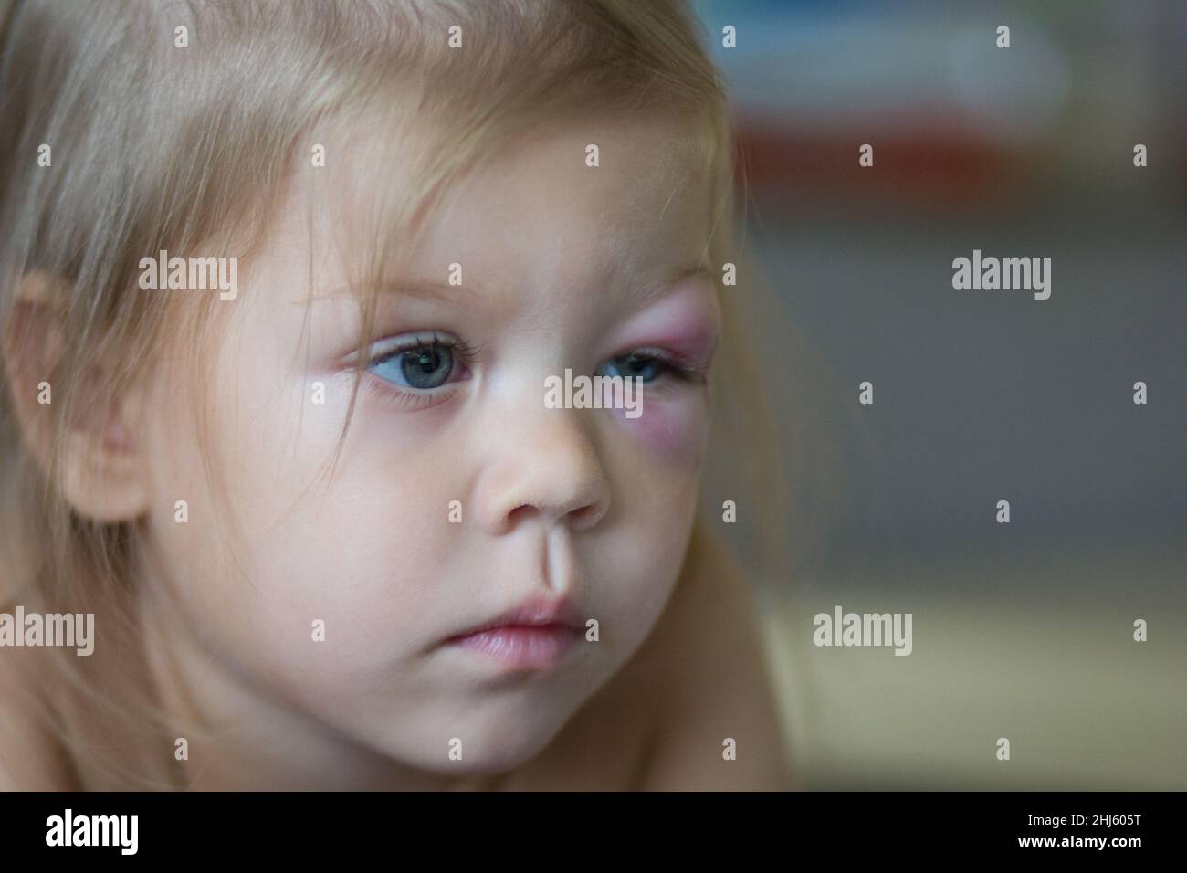 Portrait of caucasian child of two years old with bruise on face on ...