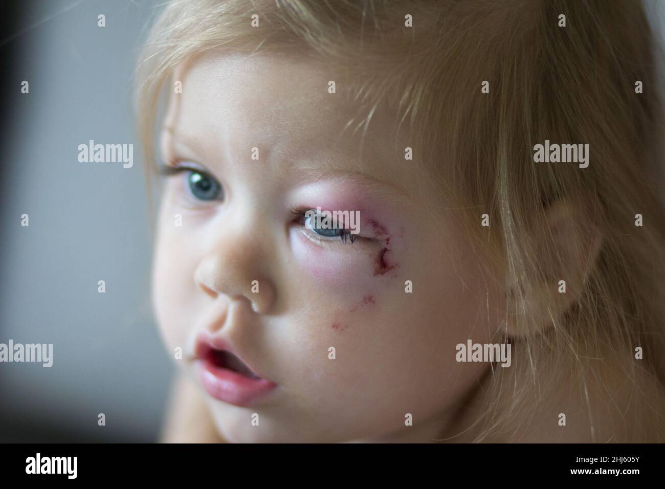 Portrait of caucasian child of two years old with bruise on face on ...