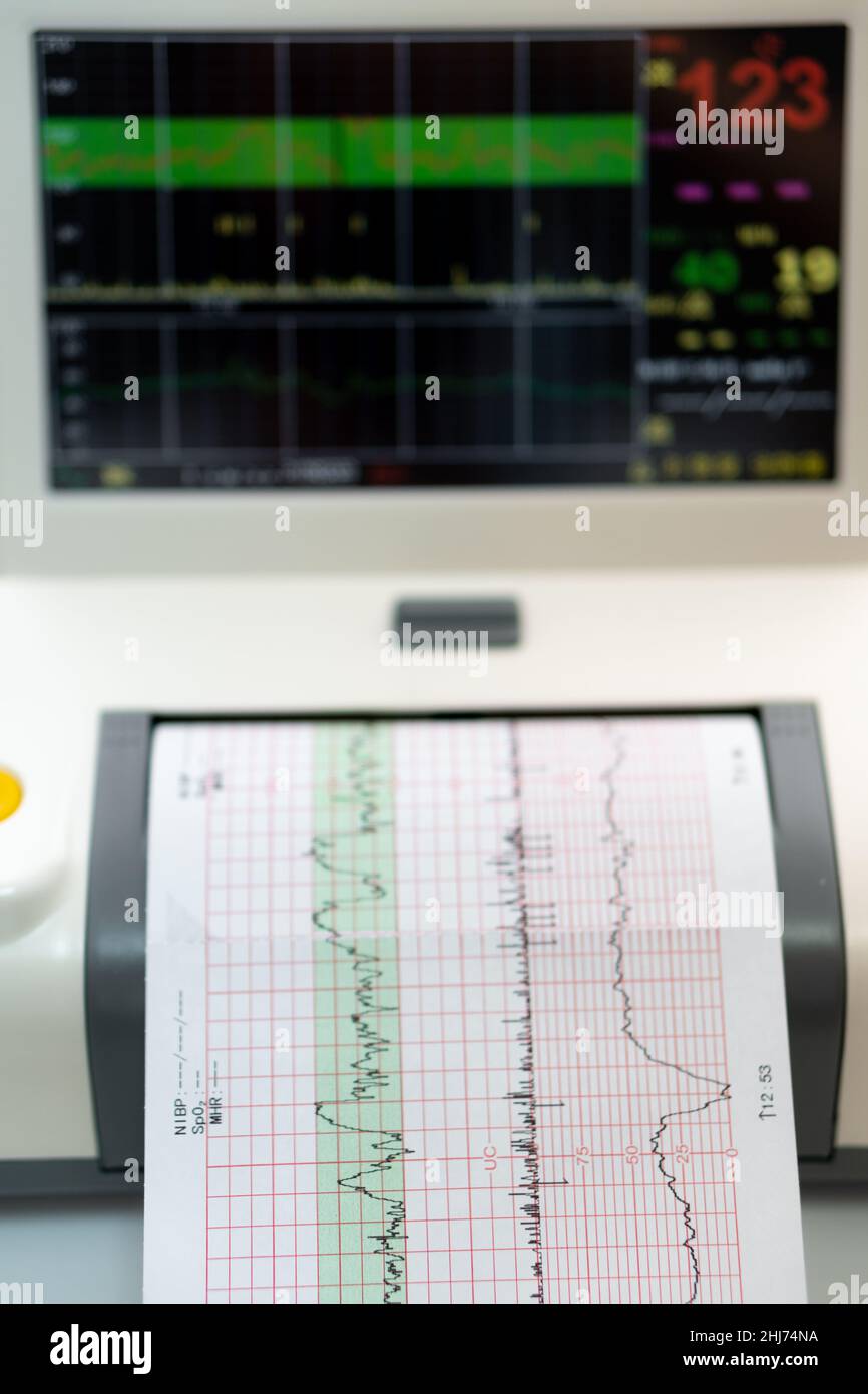 Electronic Cardiotocography Machine Monitoring Fetal Heart Contractions ...