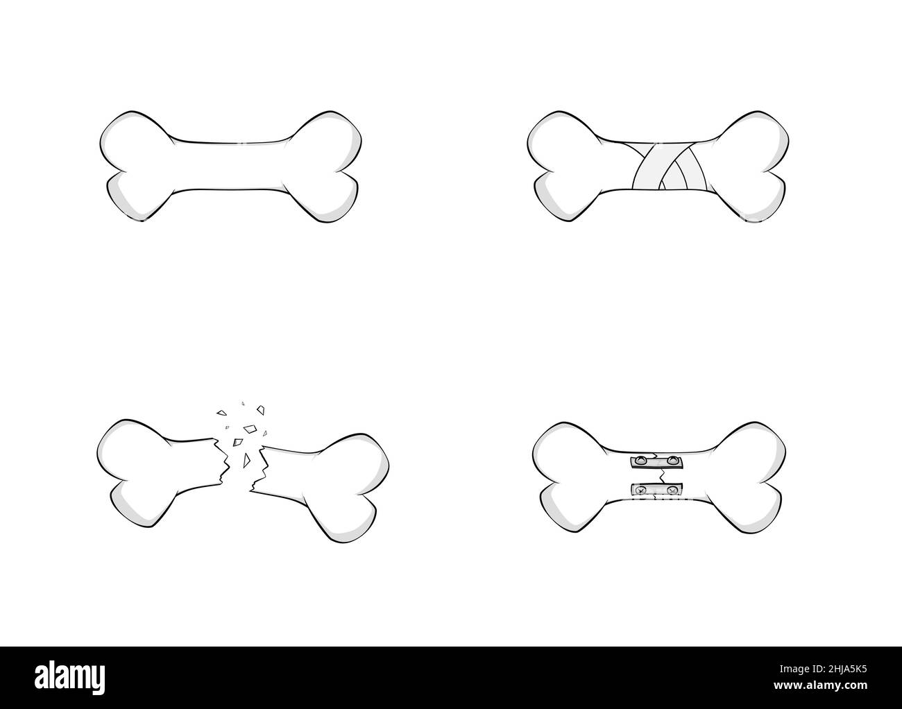 Broken bone fracture fixation plates, screws, nails, rods. Healing bone ...