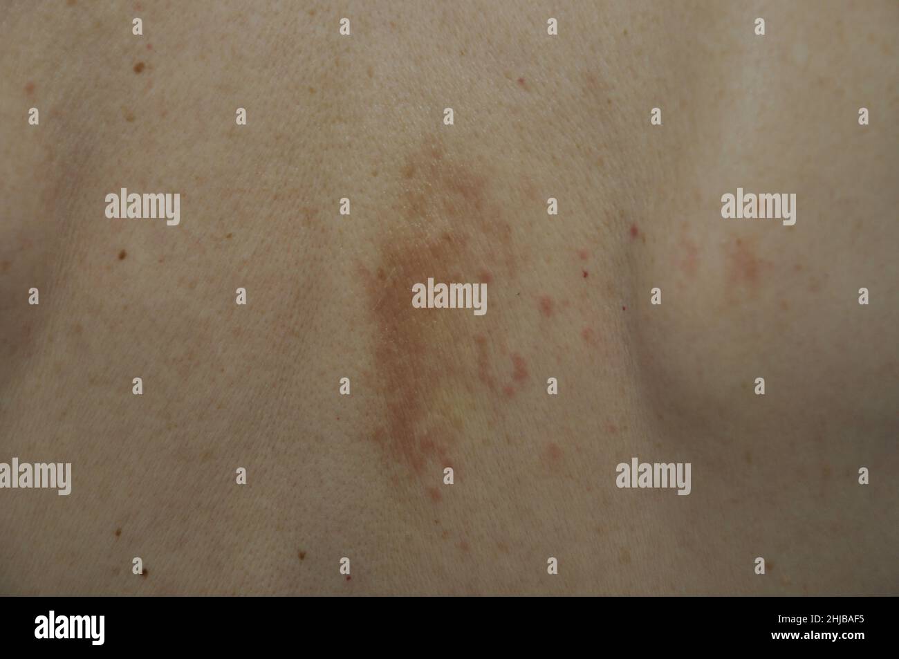 Eczema pimples on a back Stock Photo - Alamy