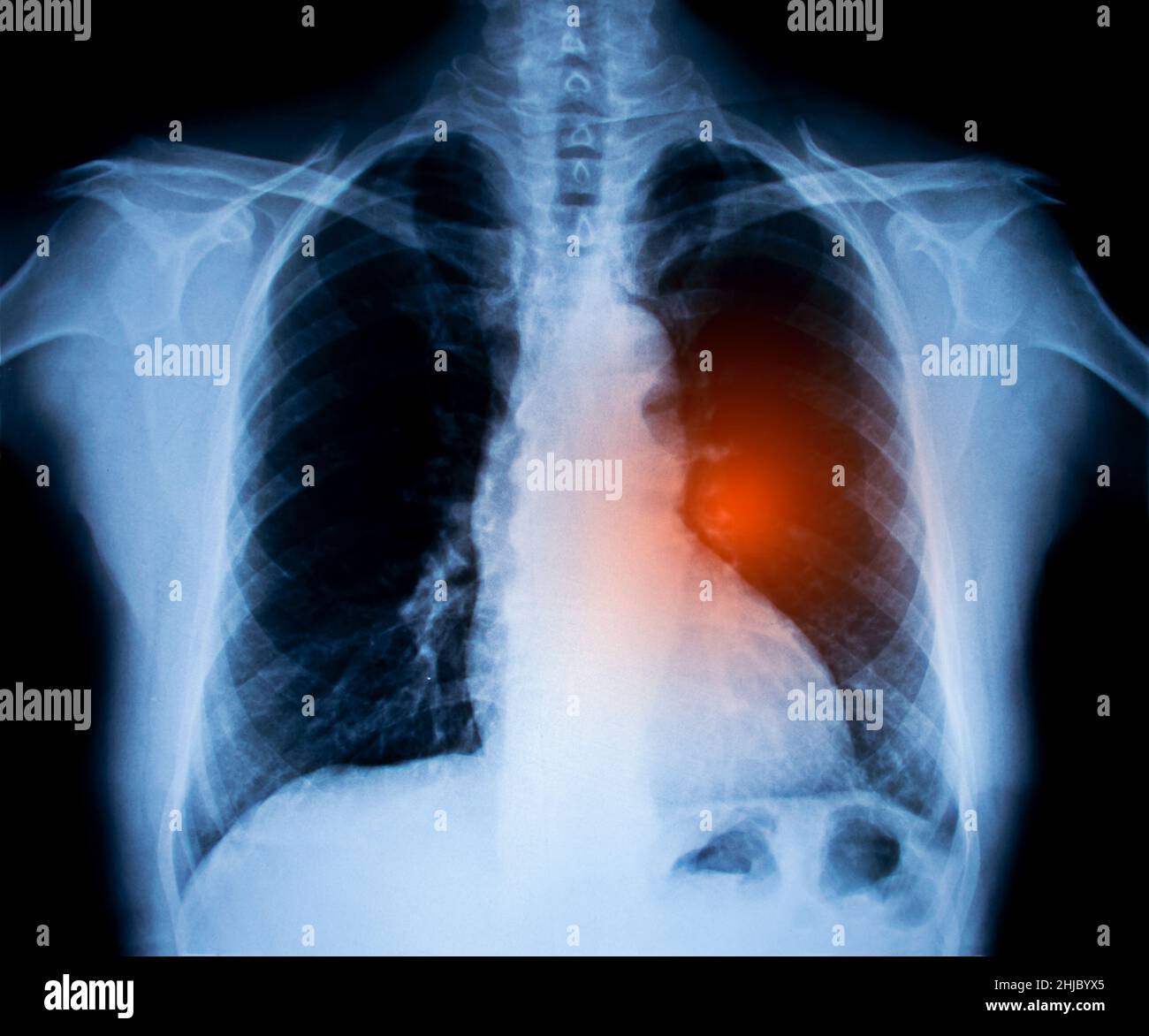Bone cancer x ray hi-res stock photography and images - Alamy