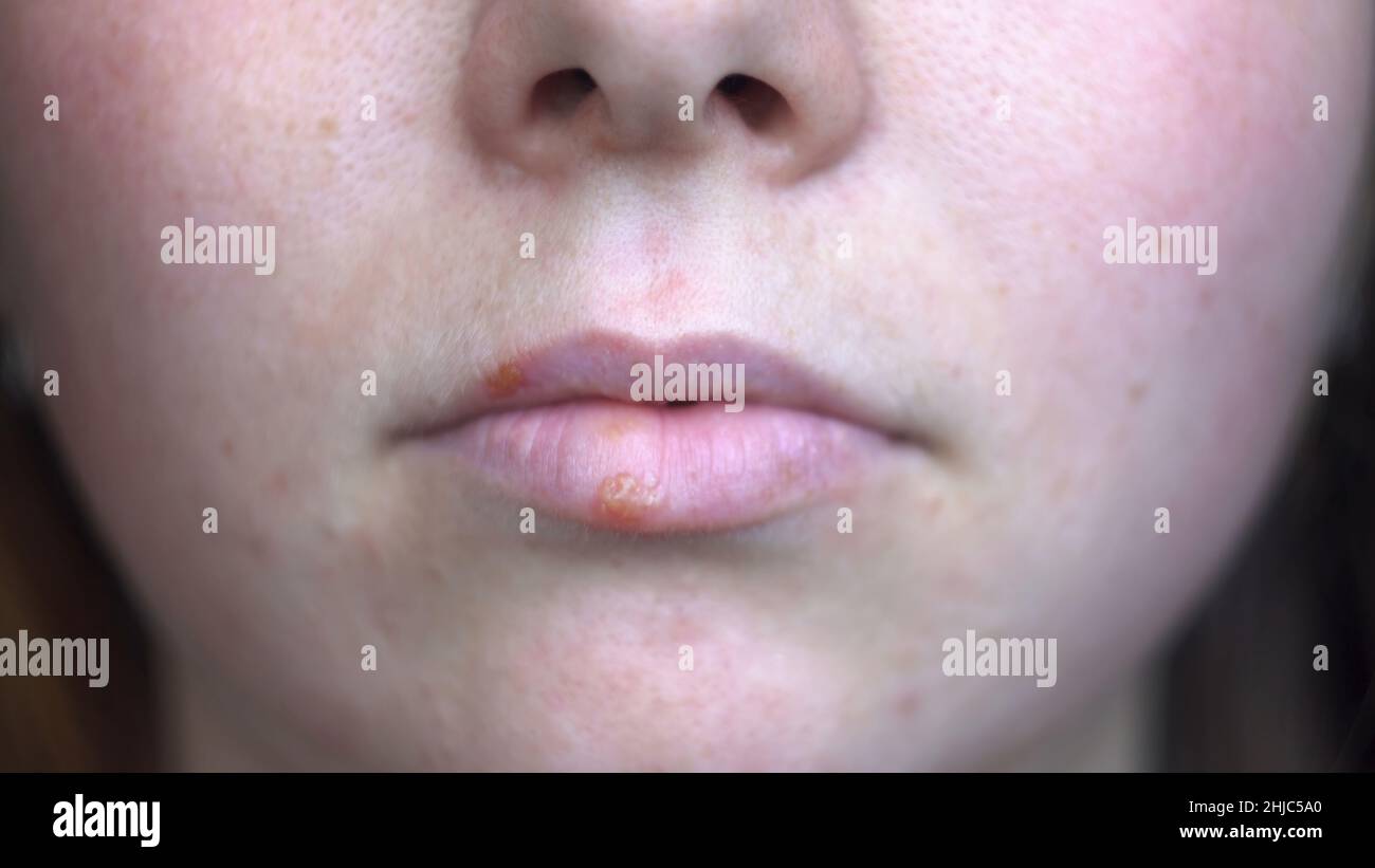 Close up of female lips infected by herpes virus. Concept of medicine ...