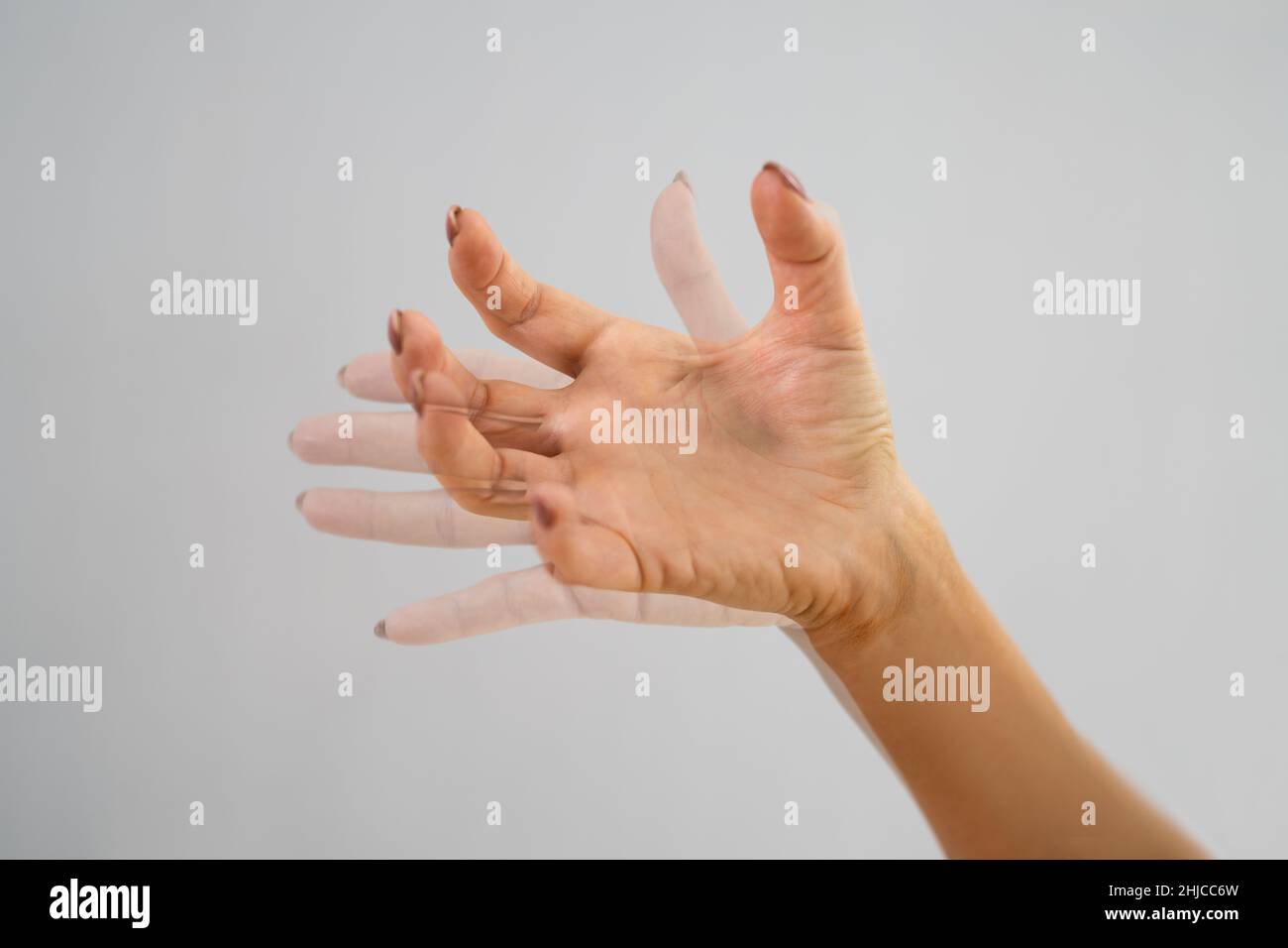 Person Hand With Dystonia. Degenerative Aging Movement Stock Photo - Alamy