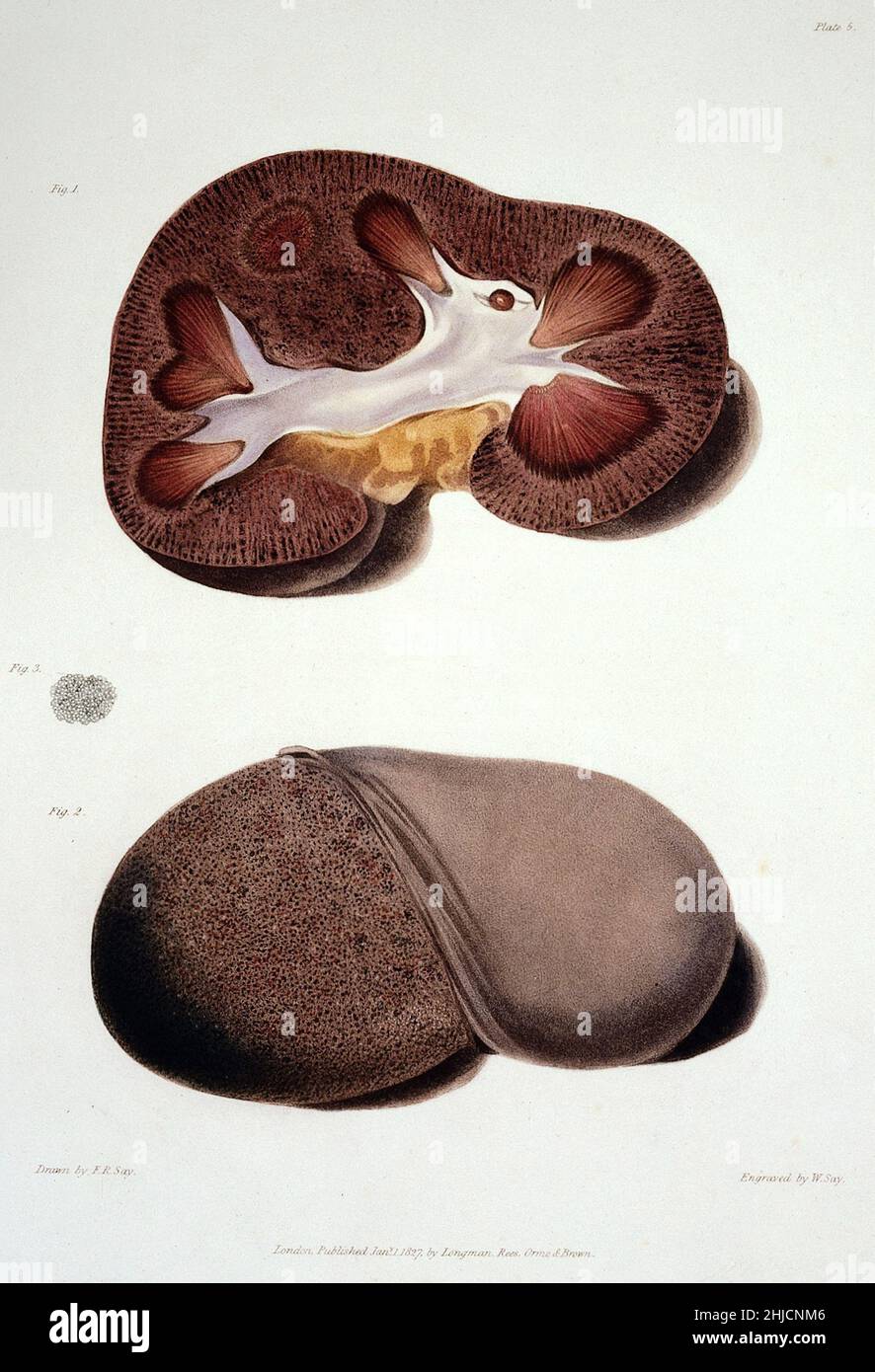 Diseased kidney sections hi-res stock photography and images - Alamy