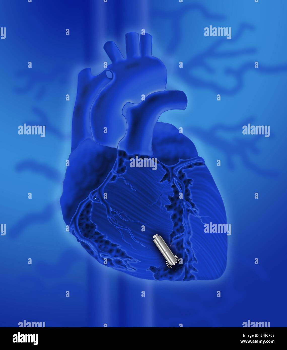 Conceptual image of a leadless pacemaker. It is much smaller than a ...